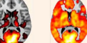 Neural Correlates of the LSD Experience Revealed by Multi-Modal ...