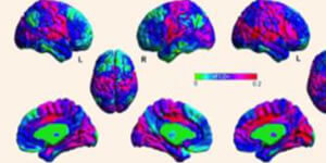 Increased Global Functional Connectivity Correlates with LSD-induced ...
